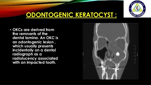 Maxillary sinus