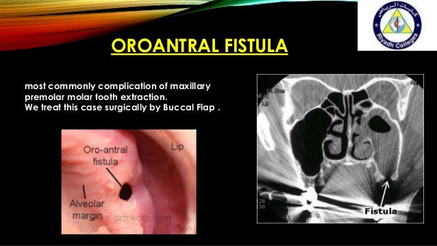 Maxillary sinus