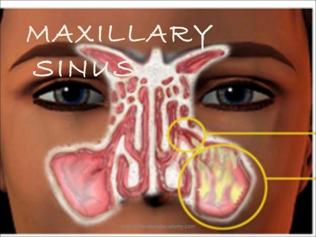 Maxillary sinus /certified fixed orthodontic courses by Indian dental…