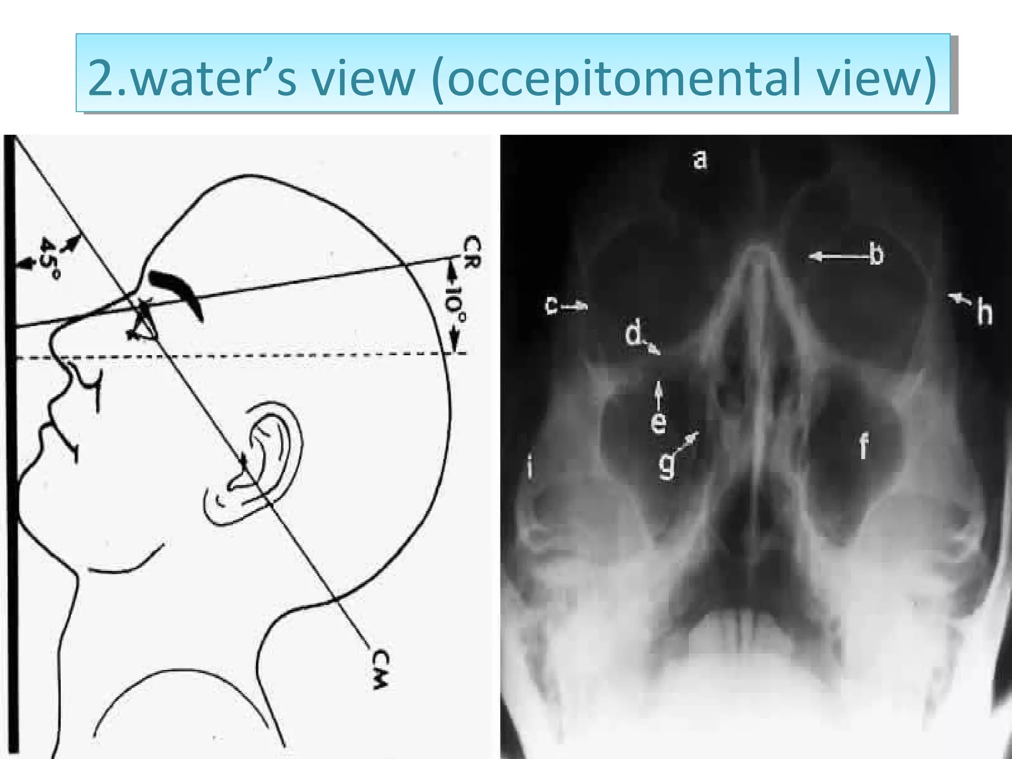 radiology of Maxillary sinus | PPT