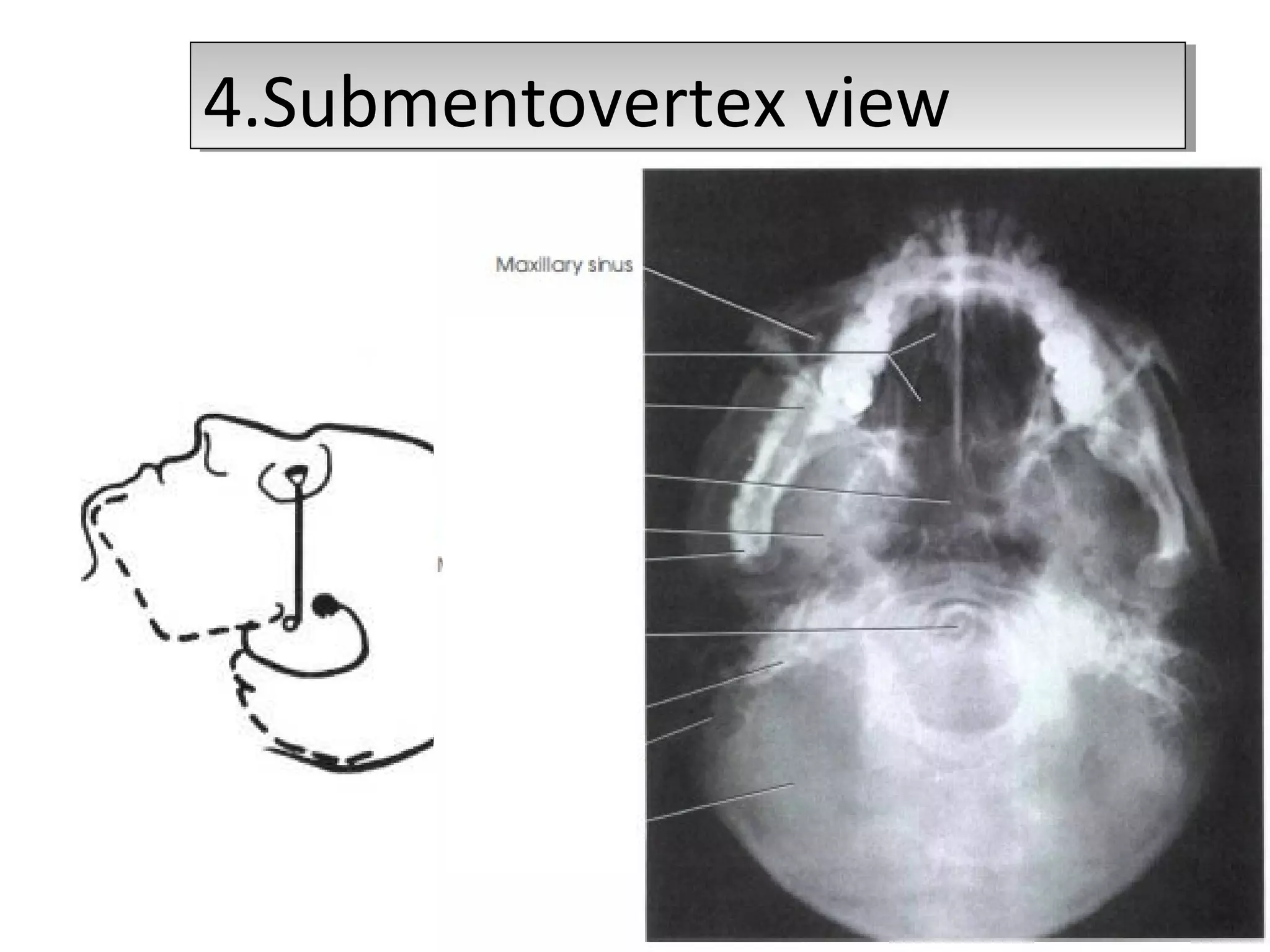 radiology of Maxillary sinus | PPT