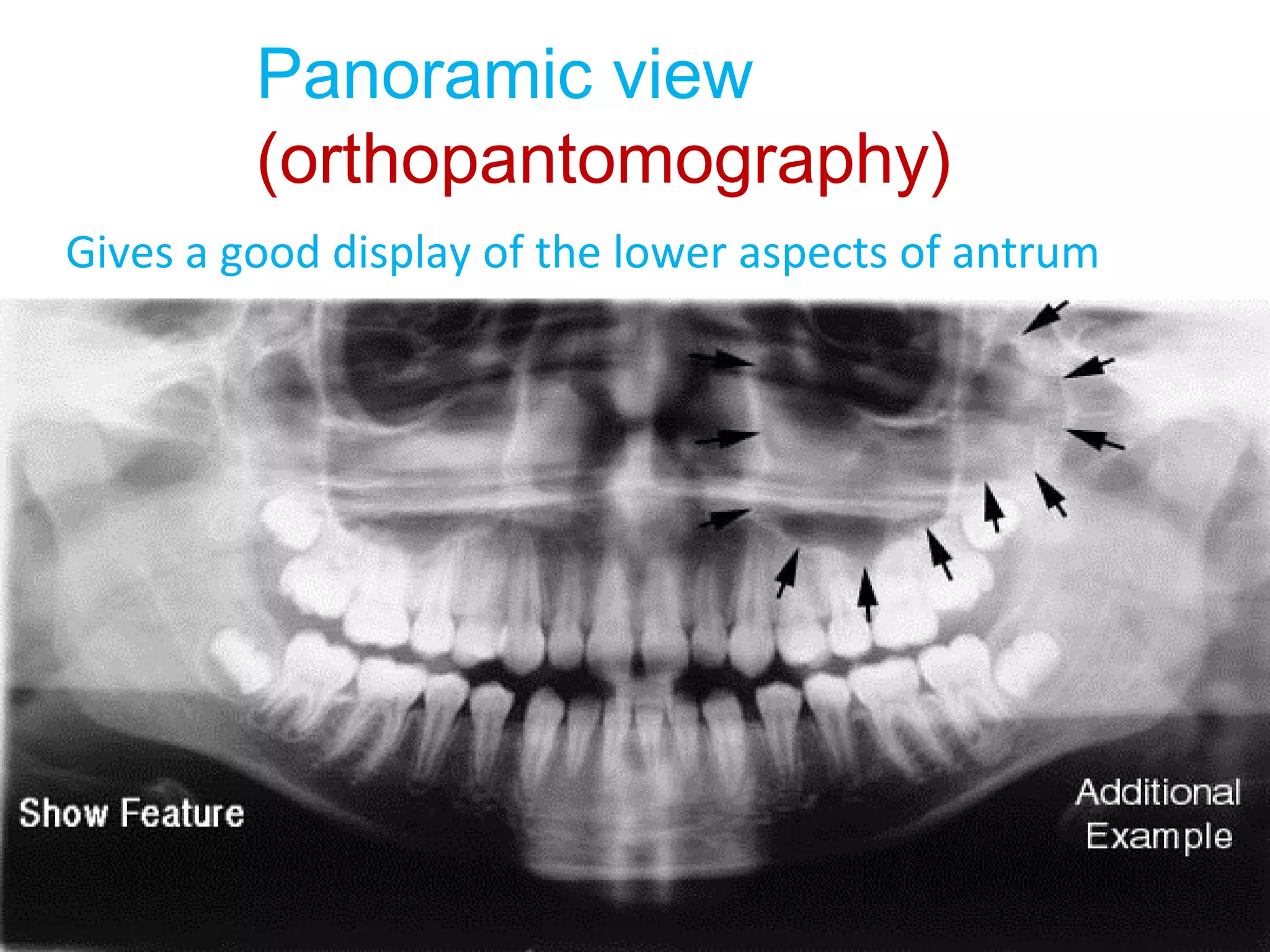 radiology of Maxillary sinus | PPT