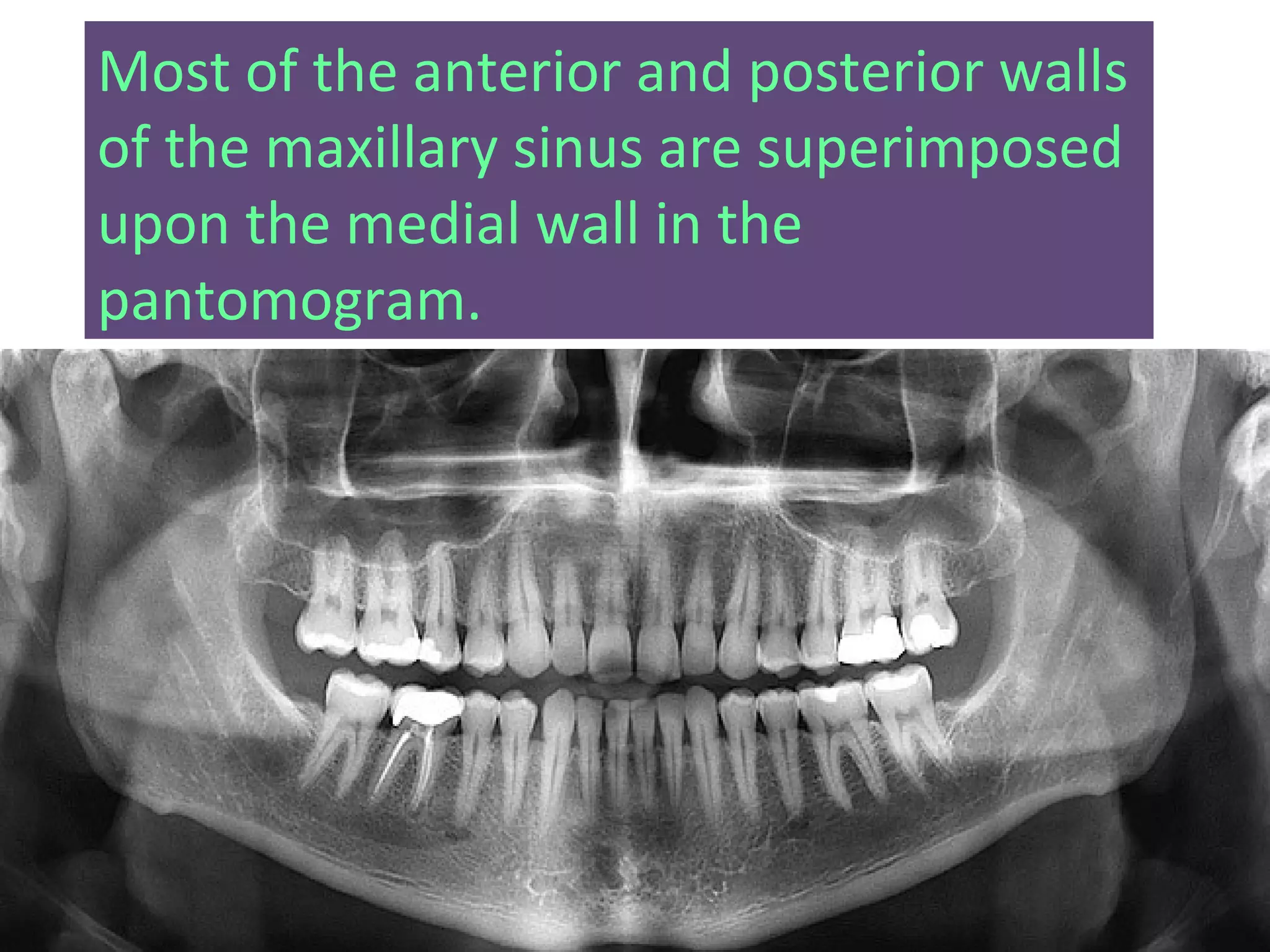 radiology of Maxillary sinus | PPT