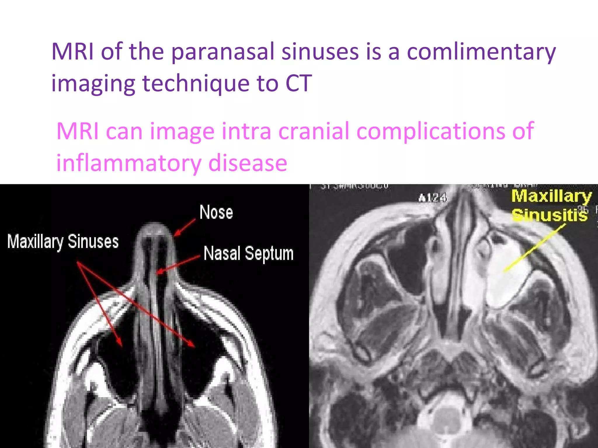 radiology of Maxillary sinus | PPT