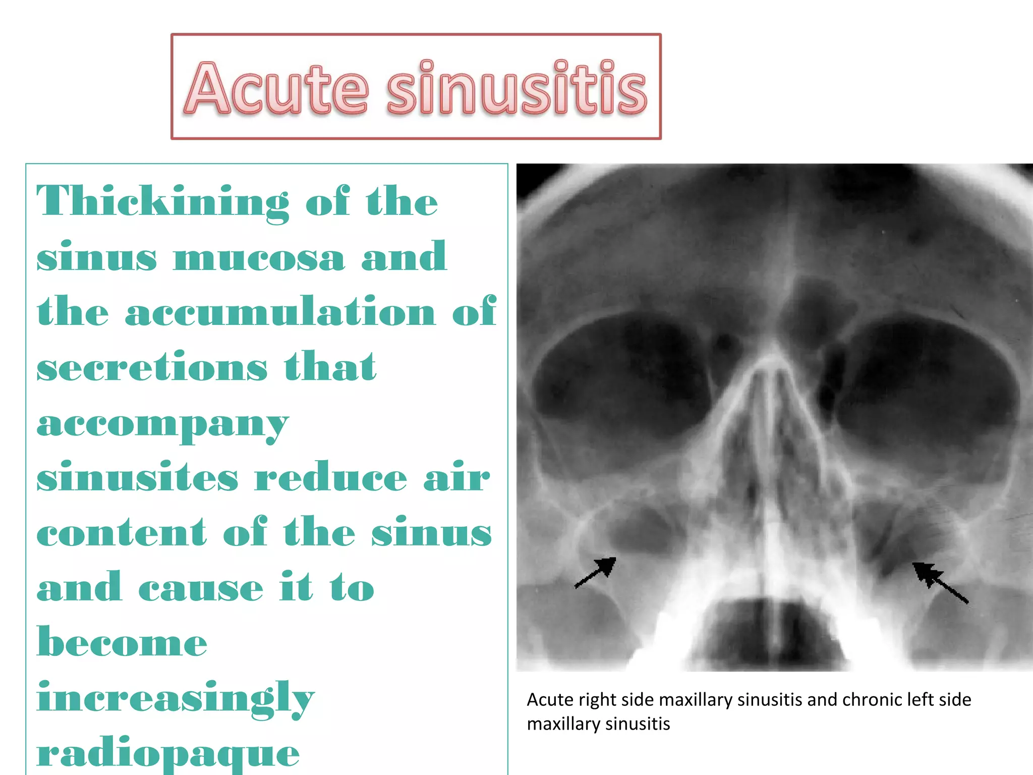 radiology of Maxillary sinus | PPT