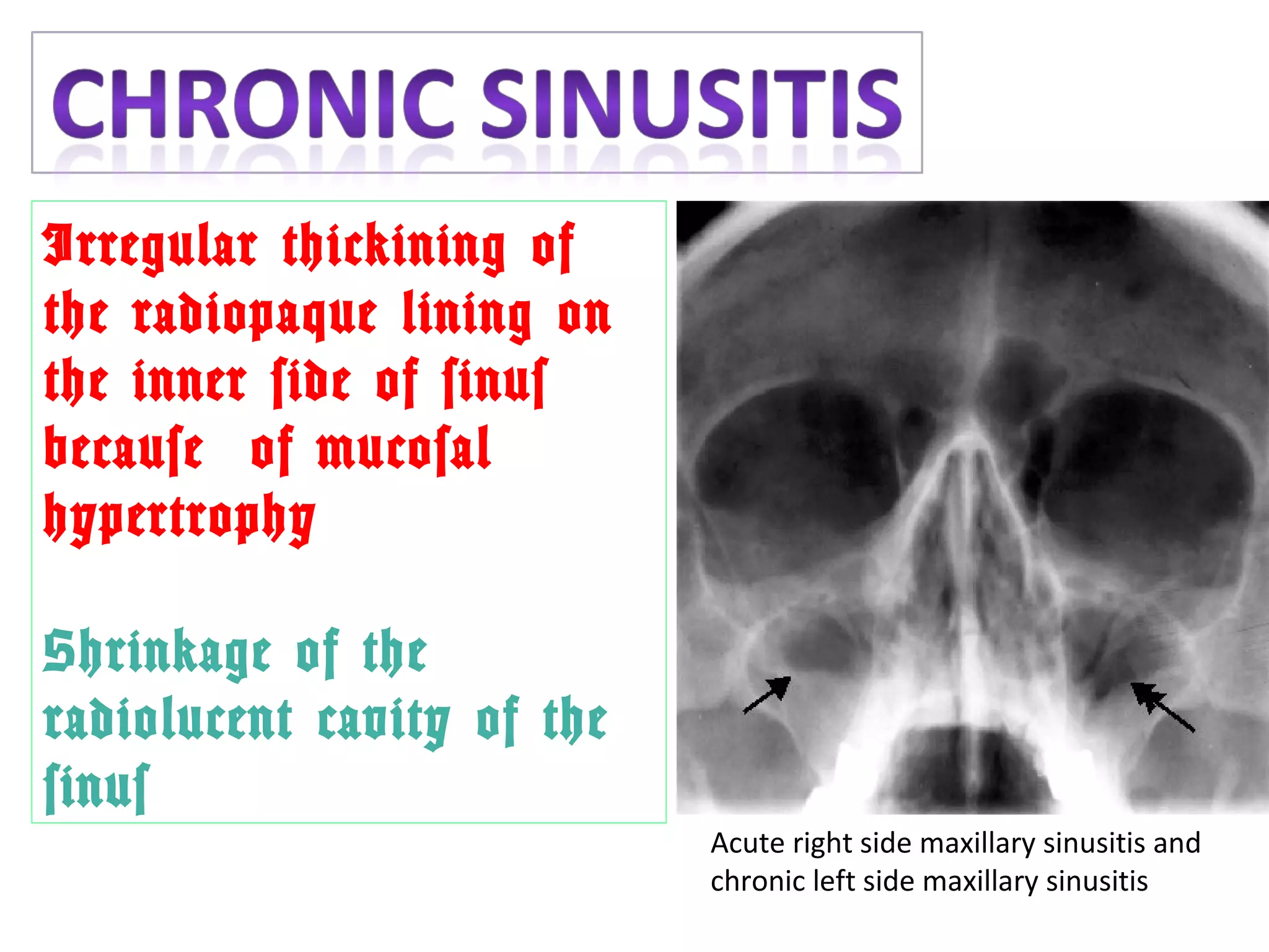 radiology of Maxillary sinus | PPT