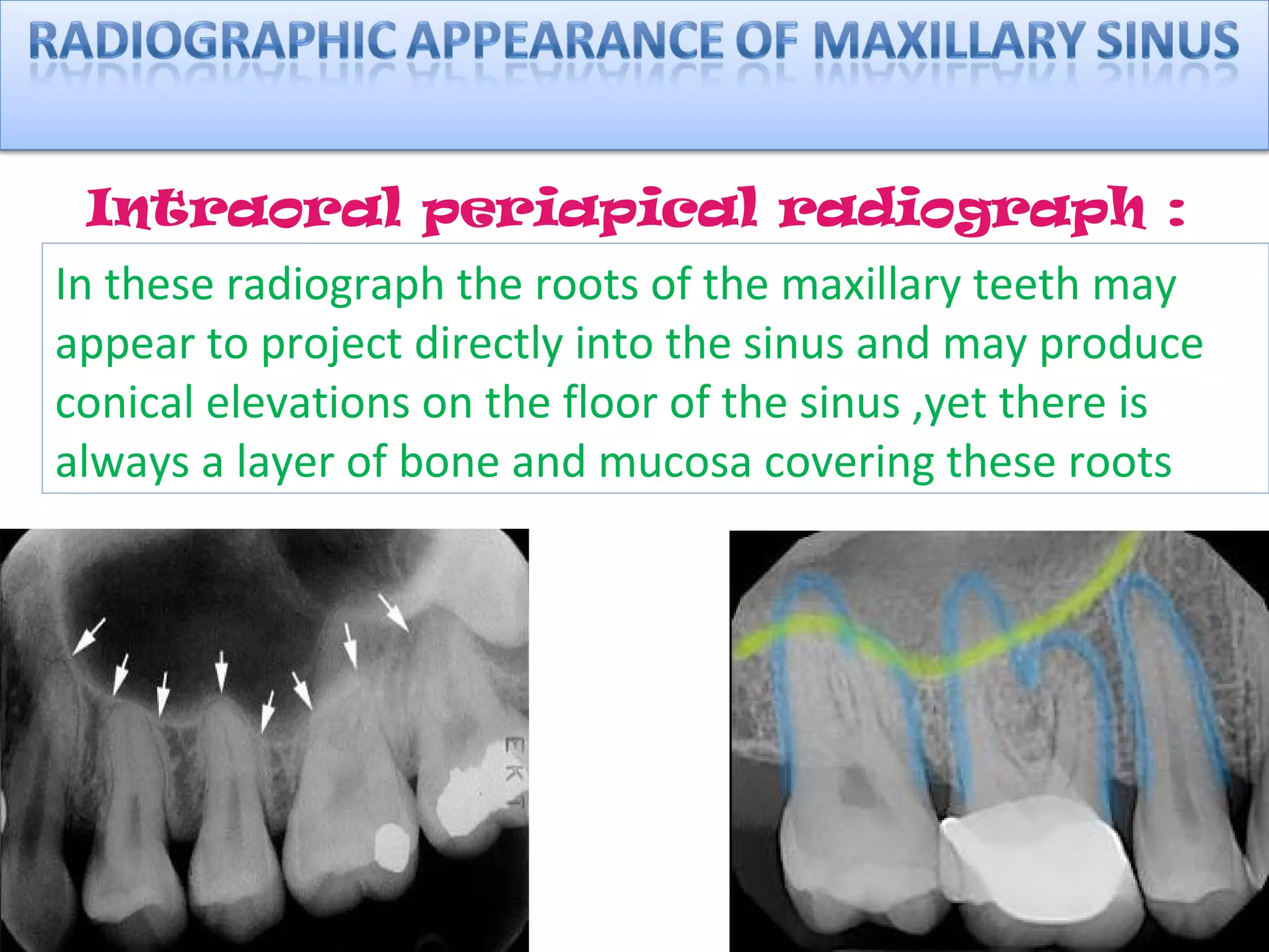 radiology of Maxillary sinus | PPT