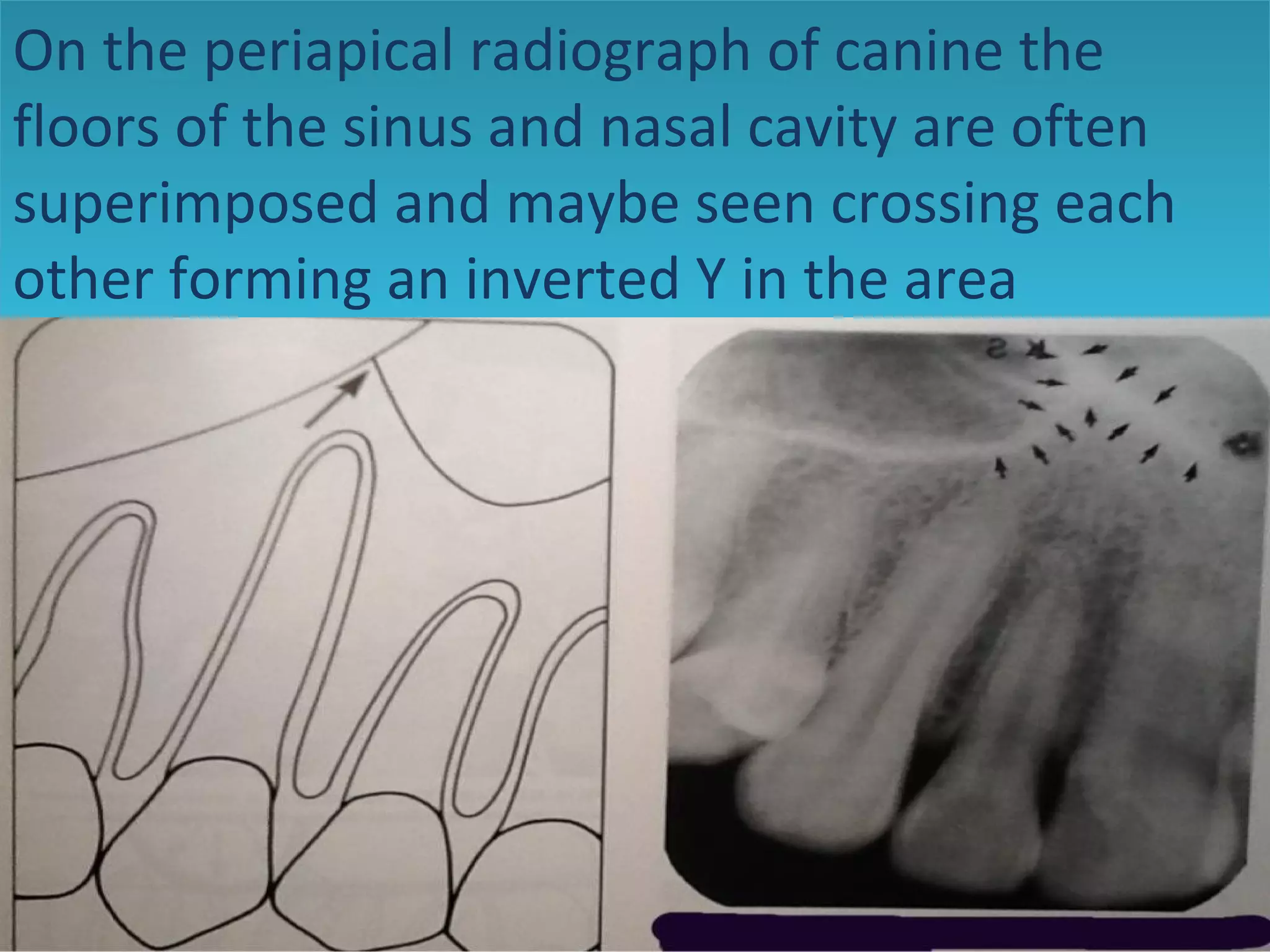 radiology of Maxillary sinus | PPT
