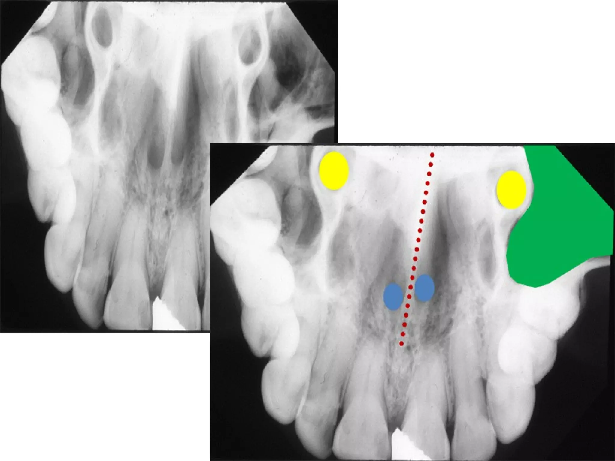 radiology of Maxillary sinus | PPT