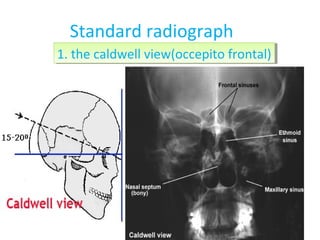 radiology of Maxillary sinus | PPT