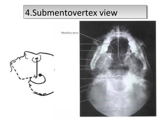 radiology of Maxillary sinus | PPT