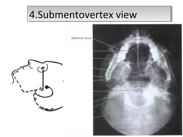 radiology of Maxillary sinus | PPT
