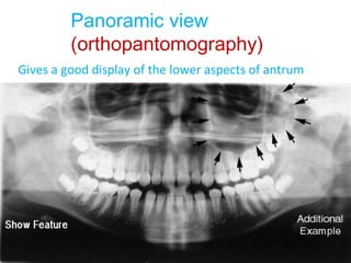 radiology of Maxillary sinus | PPT