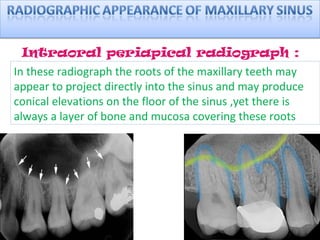 radiology of Maxillary sinus | PPT
