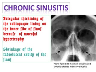 Acute Sinusitis X Ray