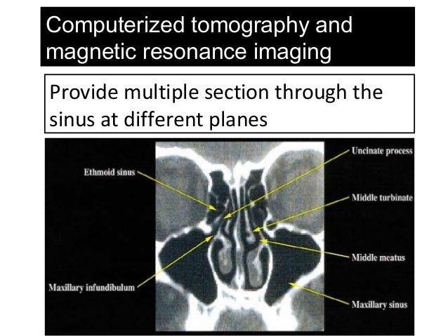 Maxillary Sinus Wall Ct Anatomy Anatomy Structure