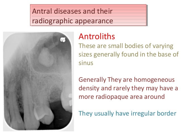radiology of Maxillary sinus