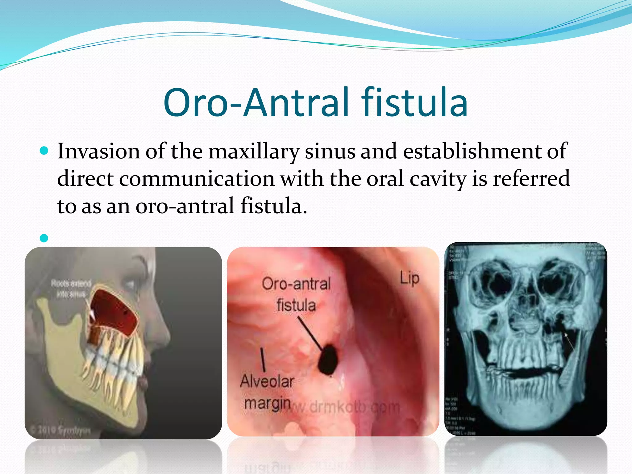 Maxillary sinus.pptx gaurav | PPTX