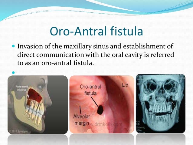 Maxillary sinus.pptx gaurav