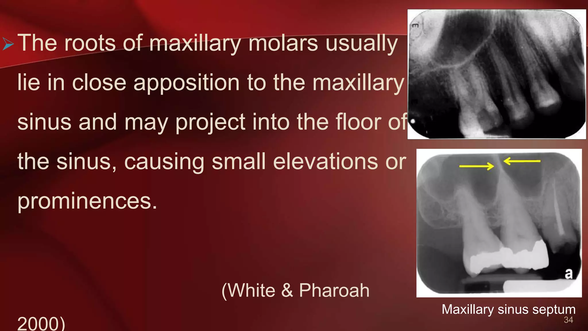 Maxillary sinus | PPTX
