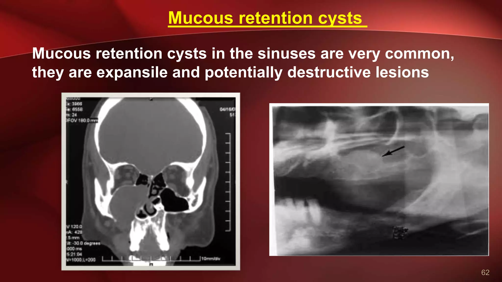 Maxillary sinus | PPTX