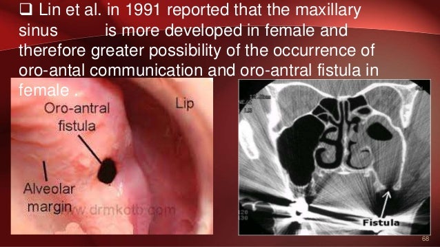 Maxillary sinus