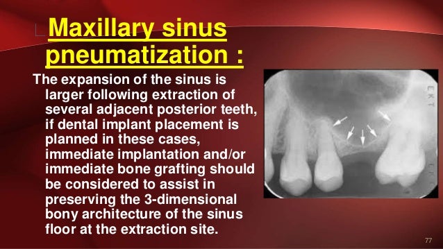 Maxillary sinus