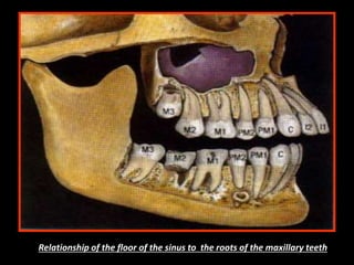 Maxillary sinus | PPTX
