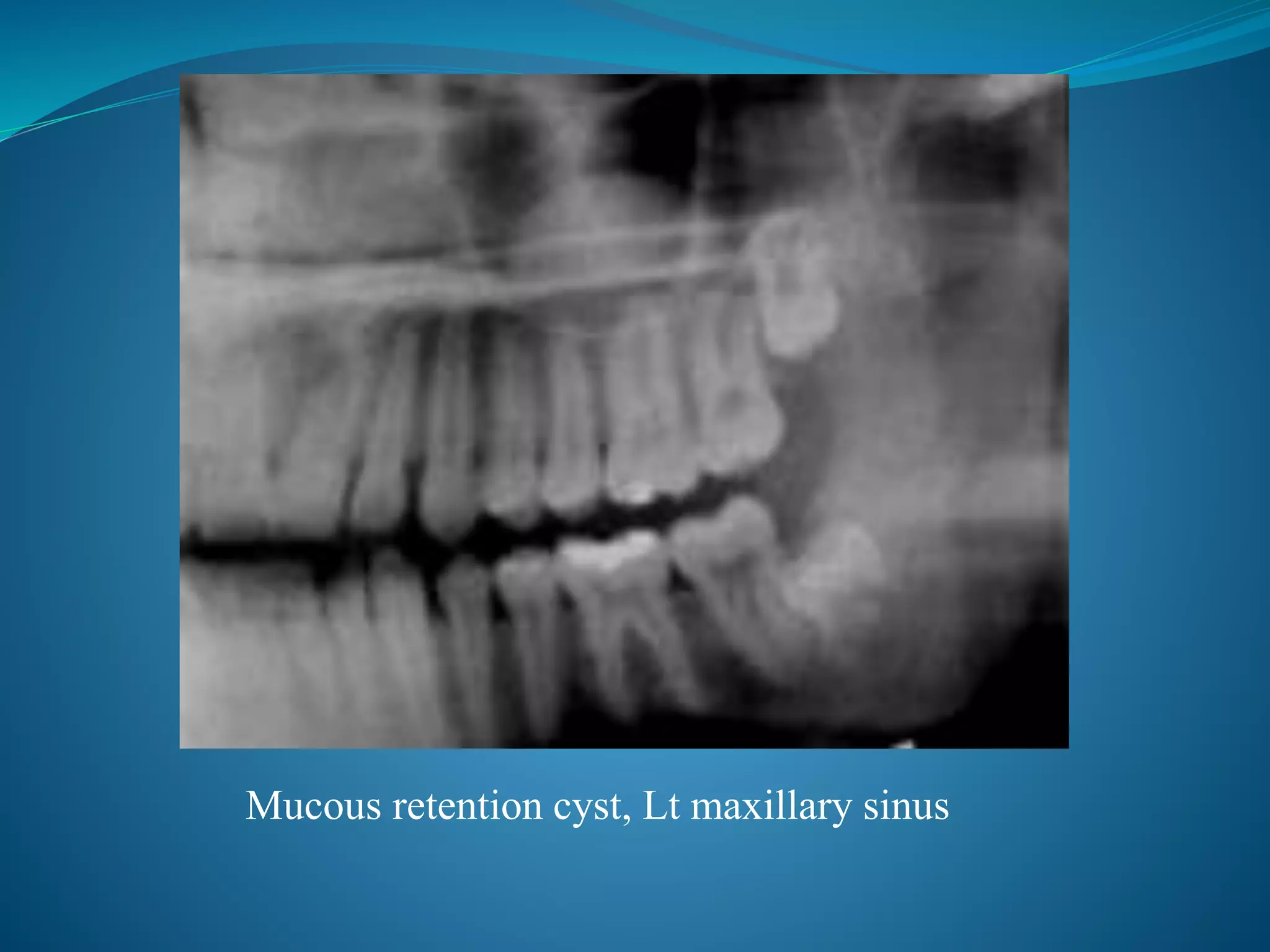 Maxillary Sinus | PPTX