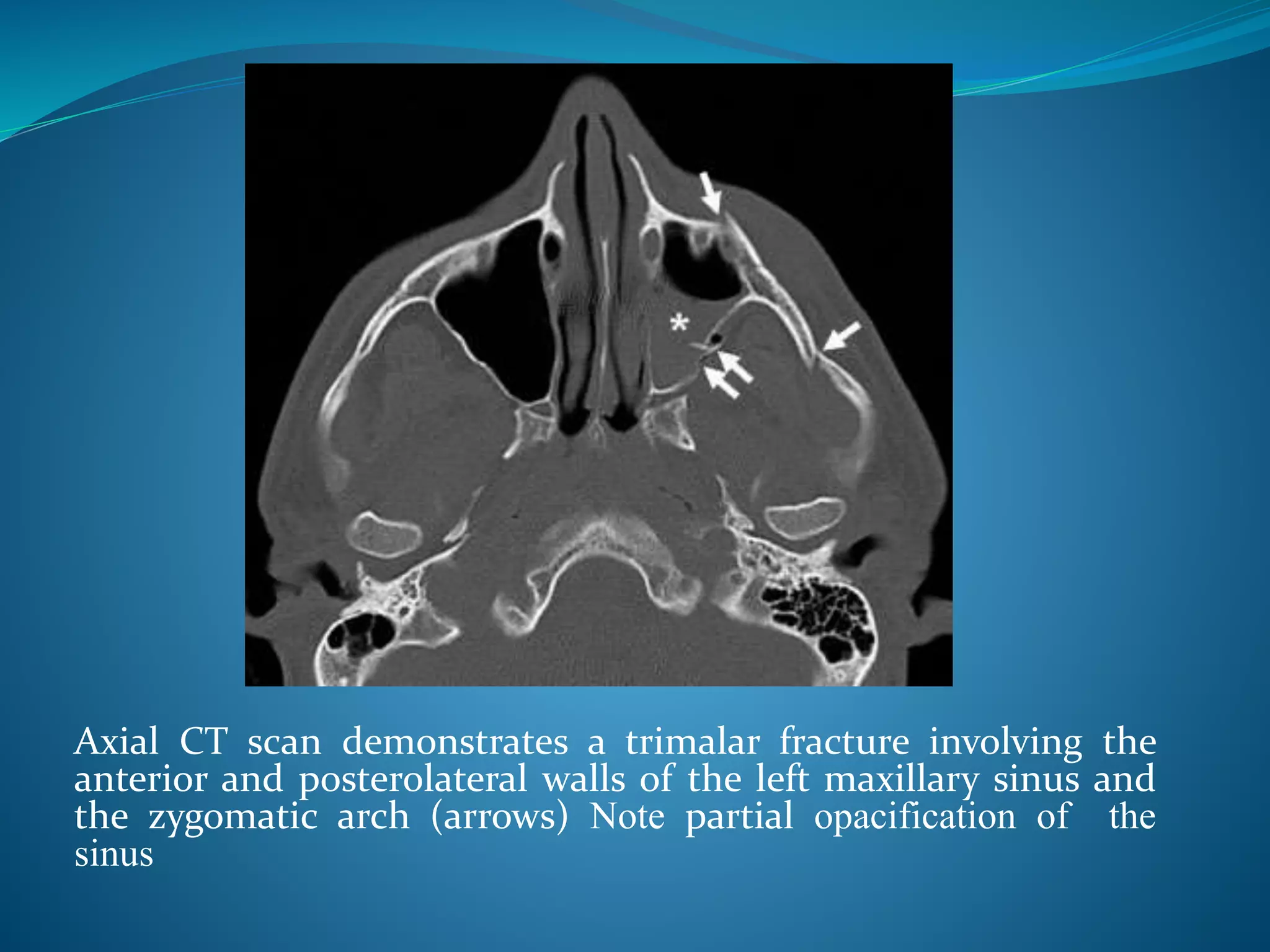 Maxillary Sinus | PPTX