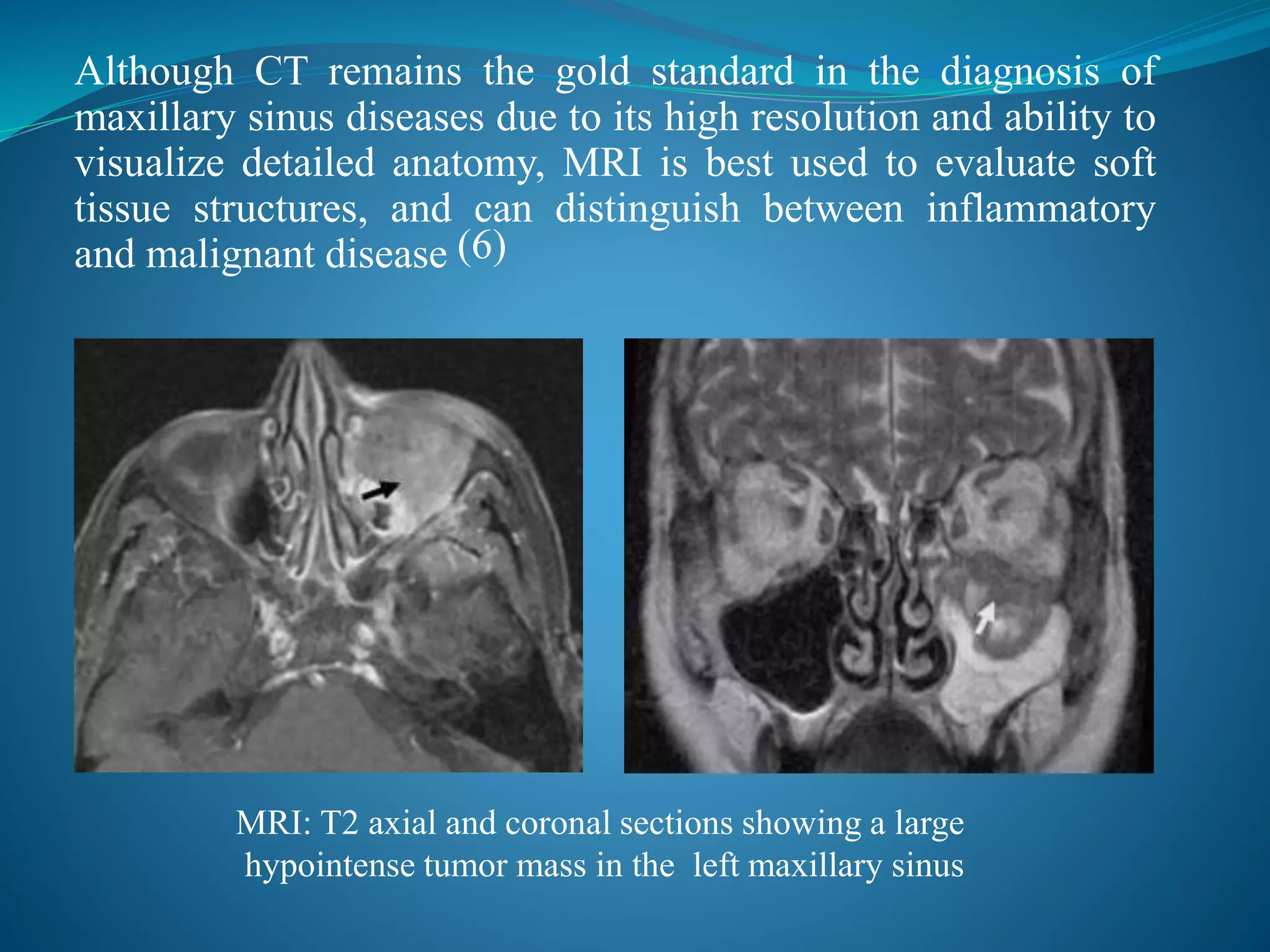 Maxillary Sinus | PPTX