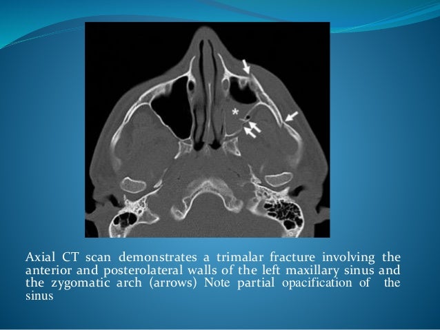 Maxillary Sinus