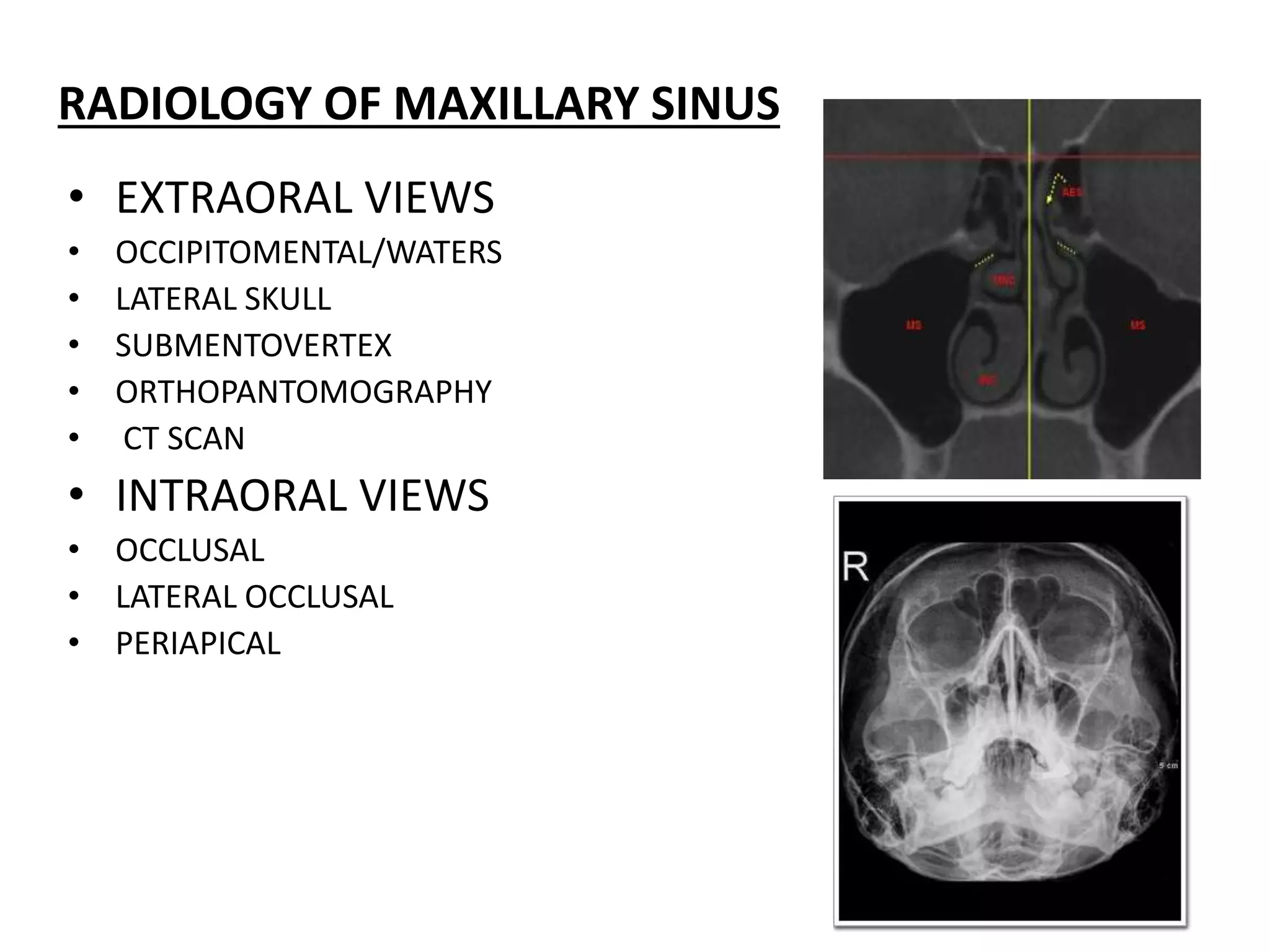 Maxillary sinus | PPTX