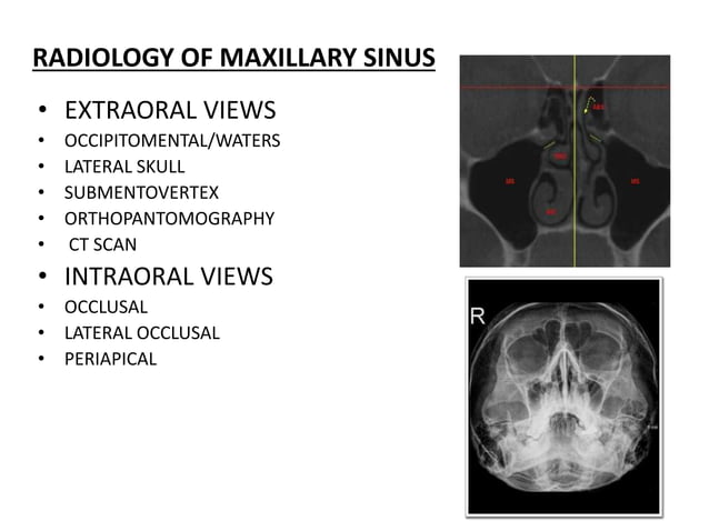 maxillarysinus-170705134531 [Autosaved].pptx