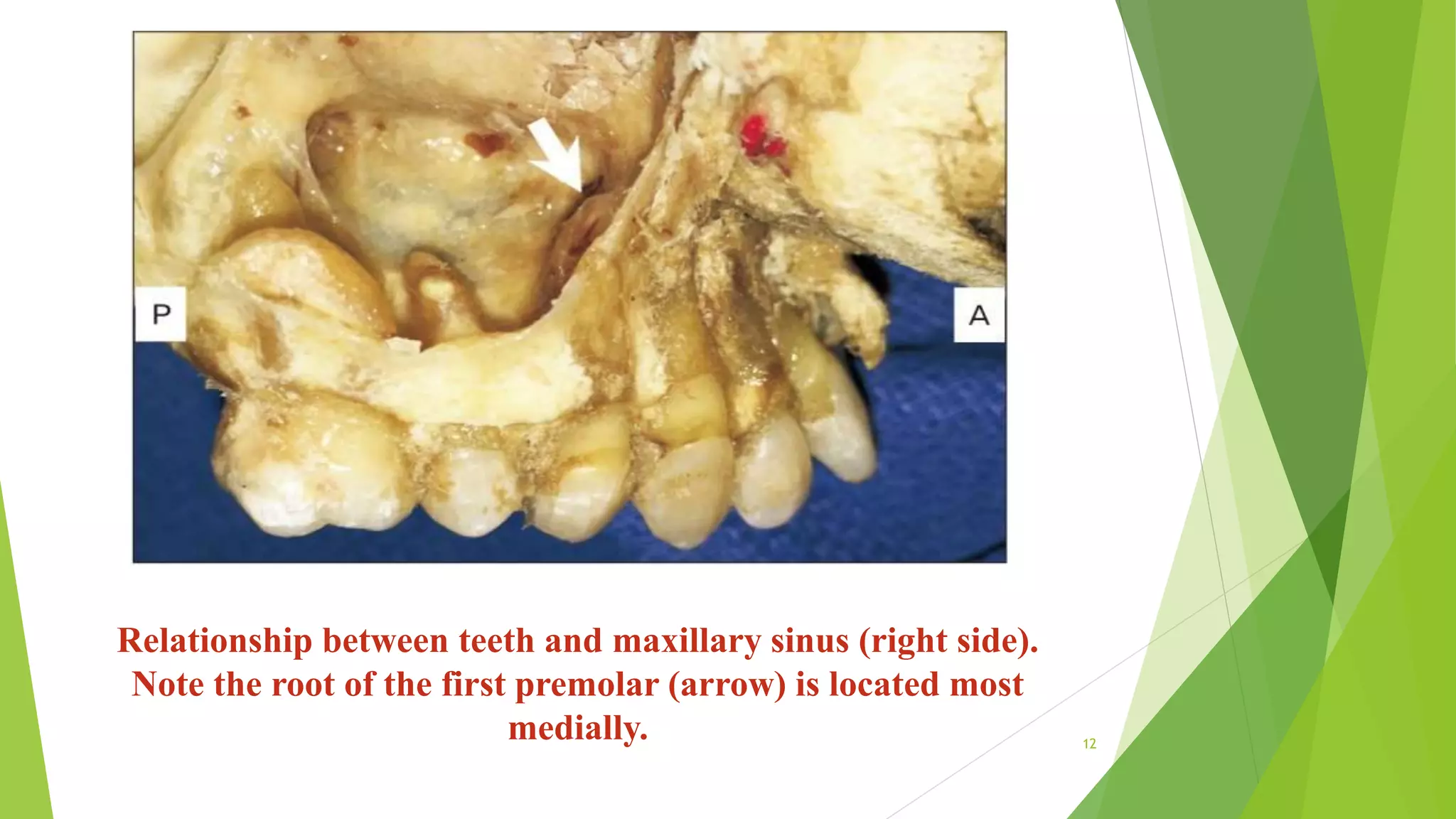 Maxillary Sinus | PPTX