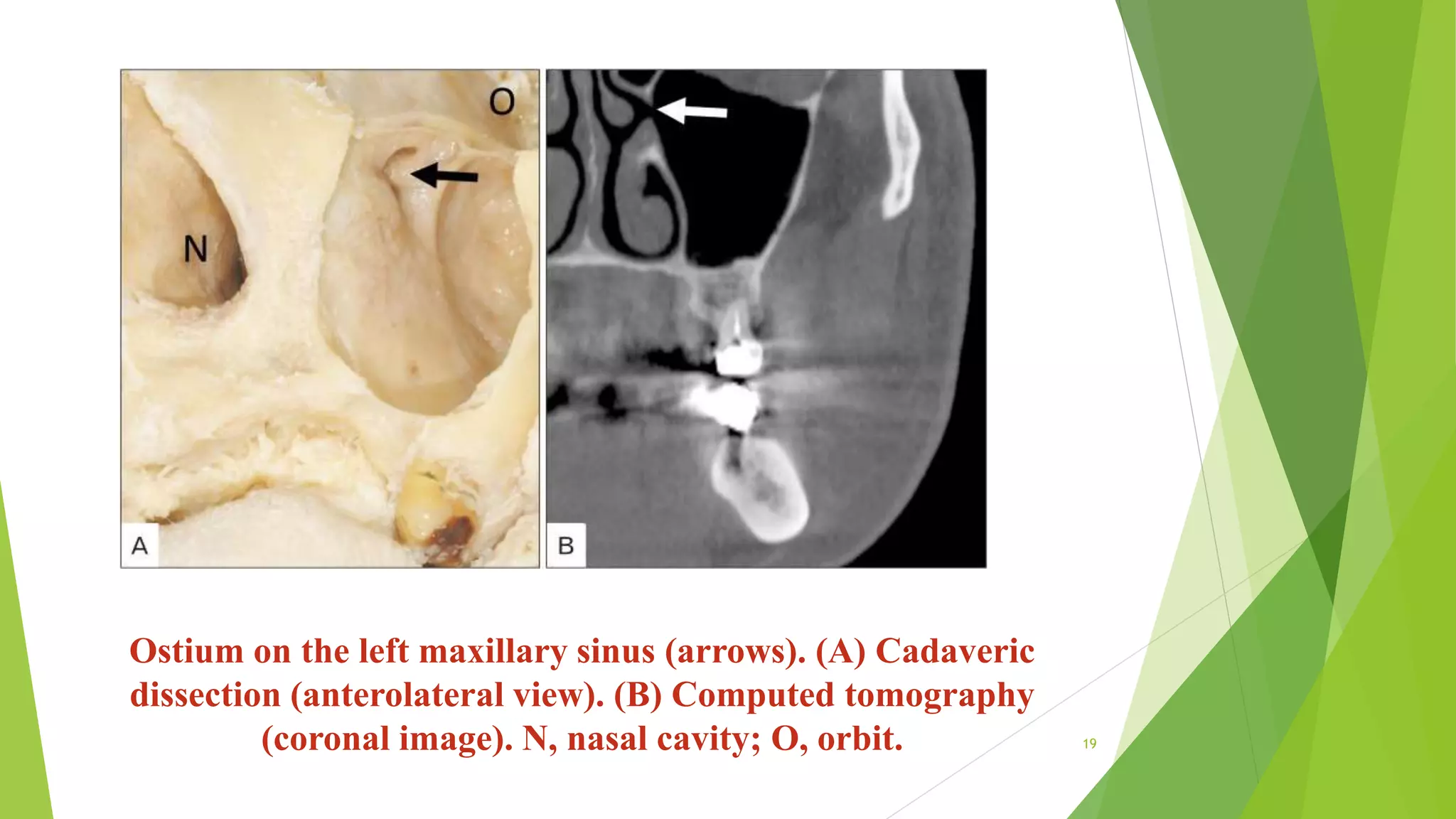 Maxillary Sinus | PPTX