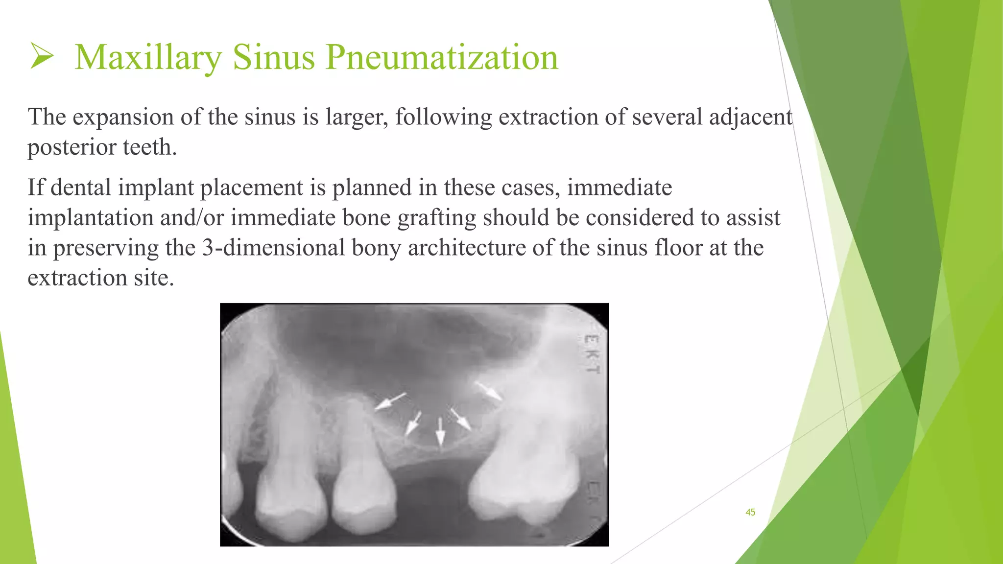 Maxillary Sinus | PPTX