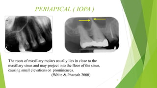 Maxillary Sinus | PPT