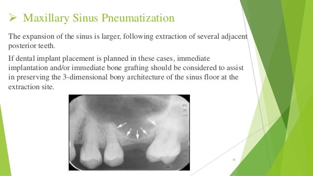 Maxillary Sinus