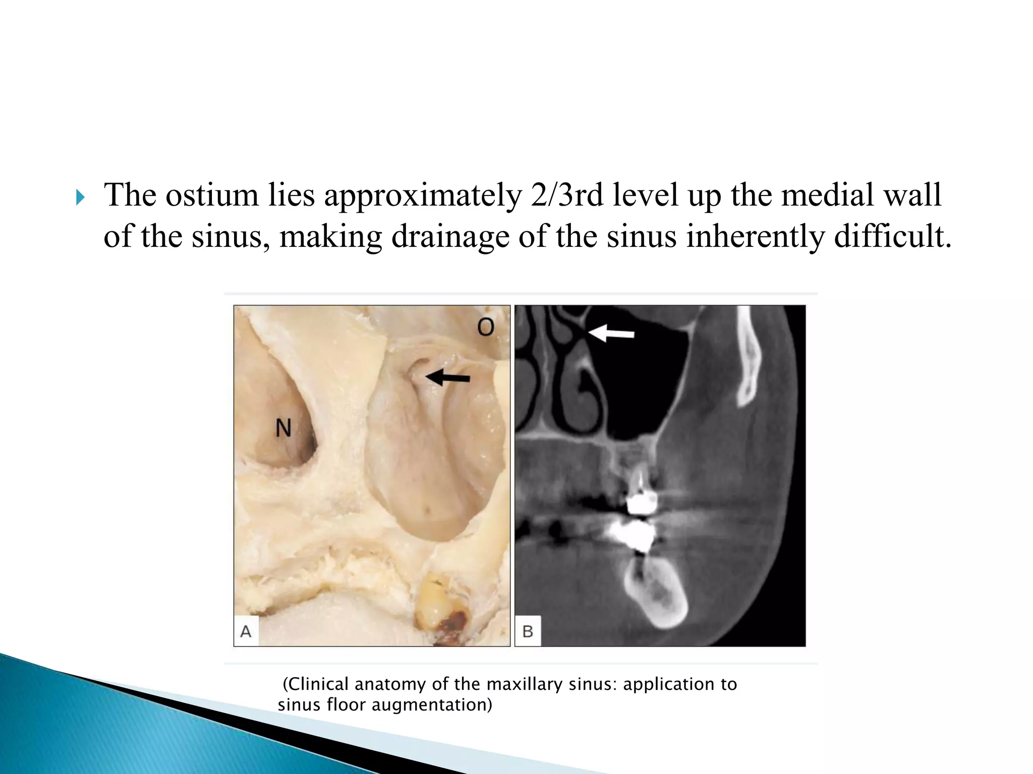 Maxillary sinus | PPTX