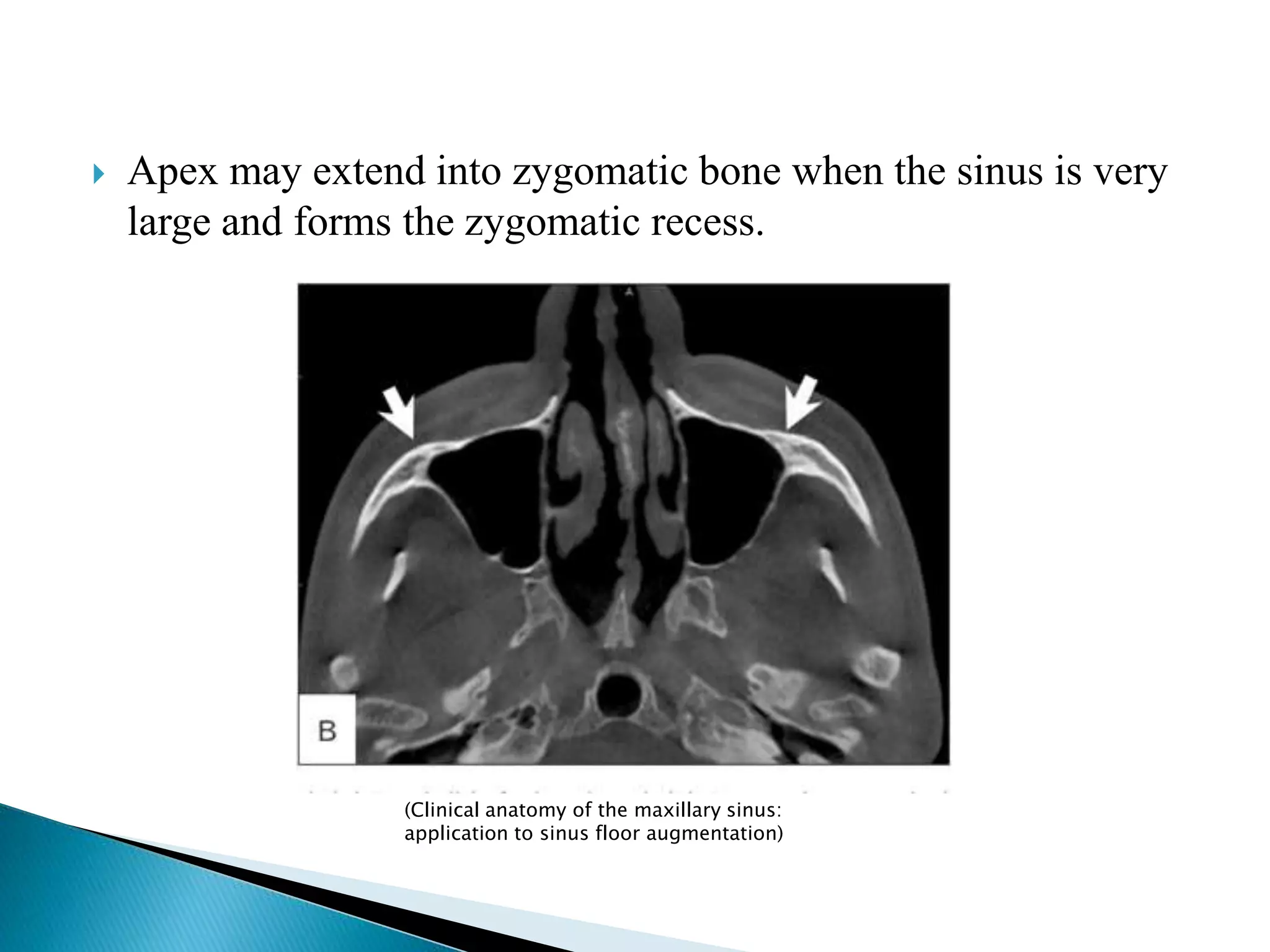 Maxillary sinus | PPTX