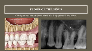 Maxillary sinus | PPTX