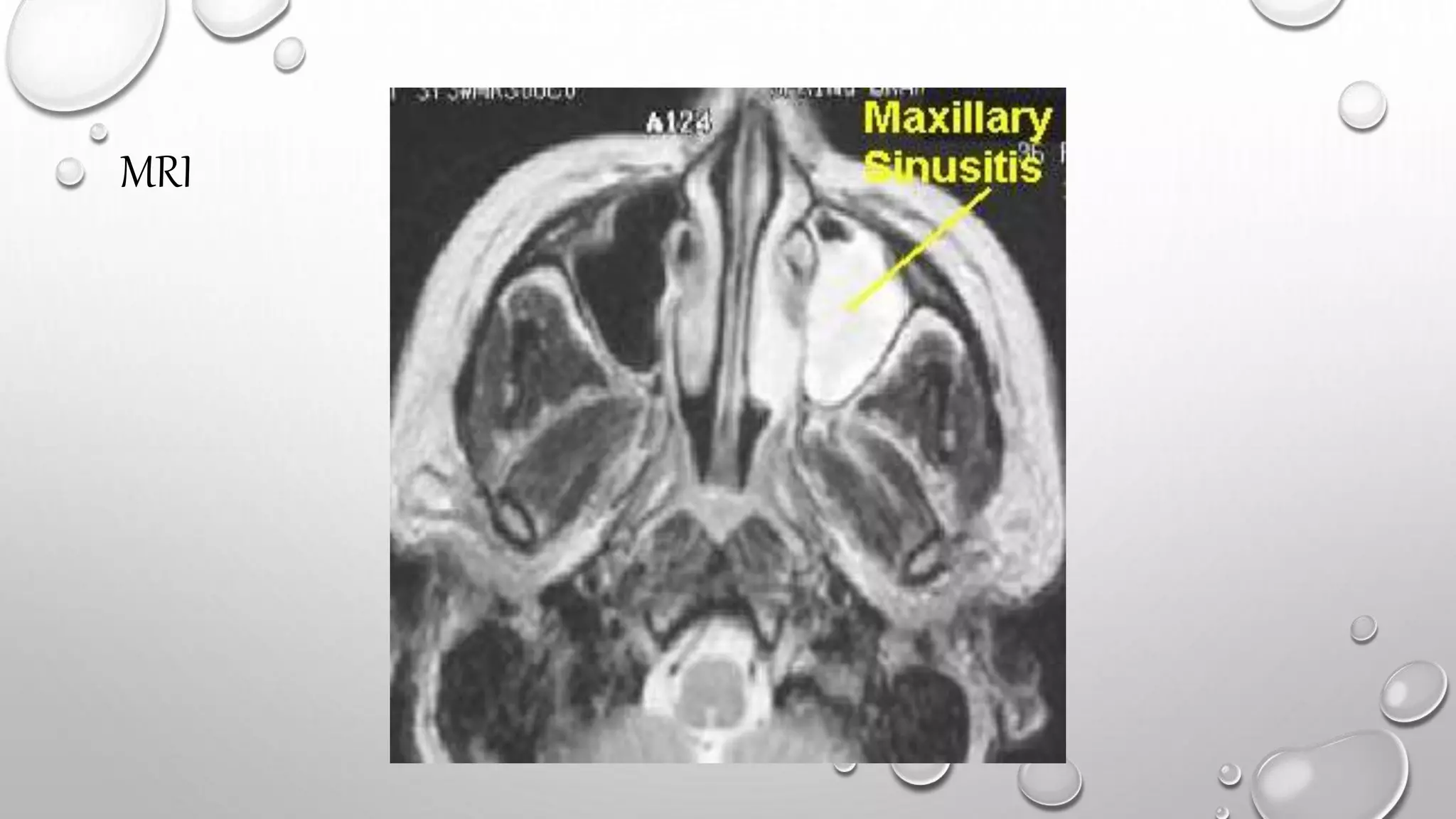 maxillary sinus | PPTX