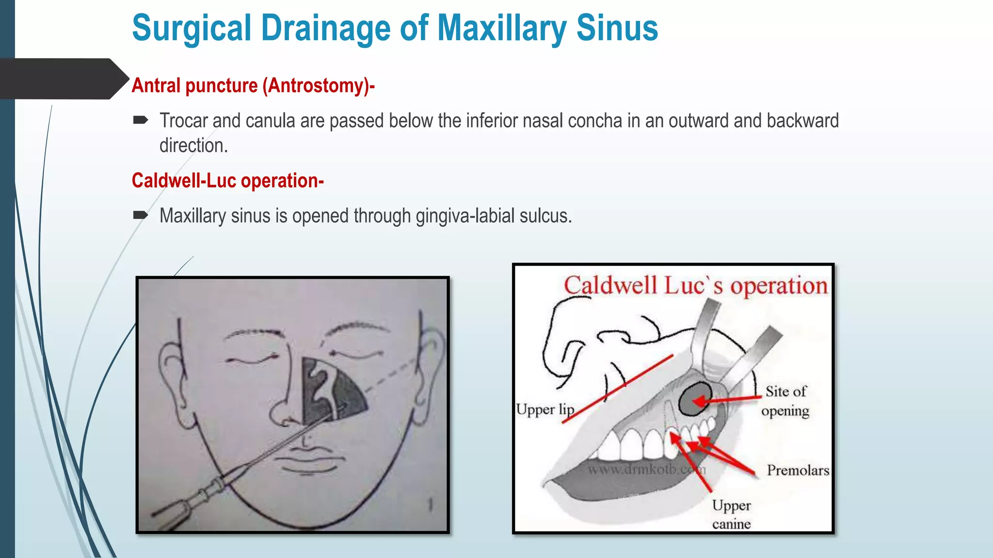 MAXILLARY SINUS.pptx | Ear, Nose and Throat Conditions | Diseases and Conditions