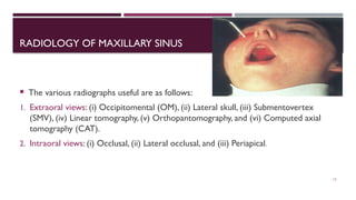 Maxillary Sinus Anatomy and infection.pptx