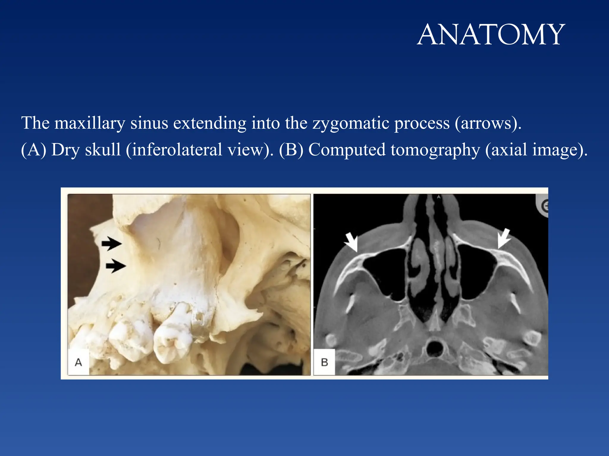 MAXILLARY SINUS - Final.pptxxxxxxxxxxxxxxx | PPTX