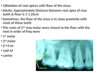 MAXILLARY SINUS AND ITS SURGICAL ANATOMY (2) (1) [Autosaved].ppt