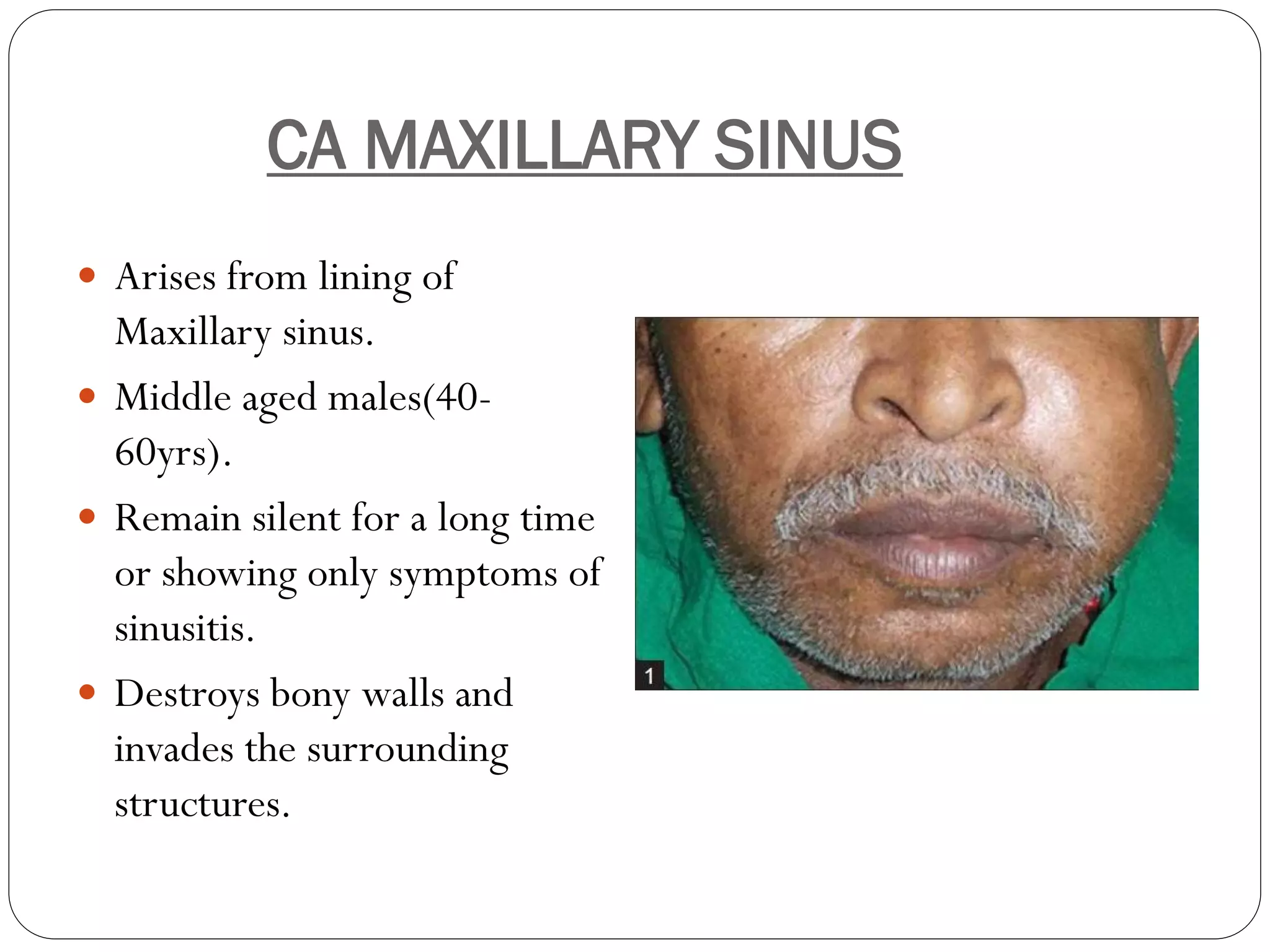 Maxillary sinus carcinoma | PPTX