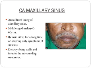 Maxillary Sinus Cancer