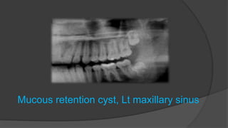 Maxillary sinus diseases | PPTX